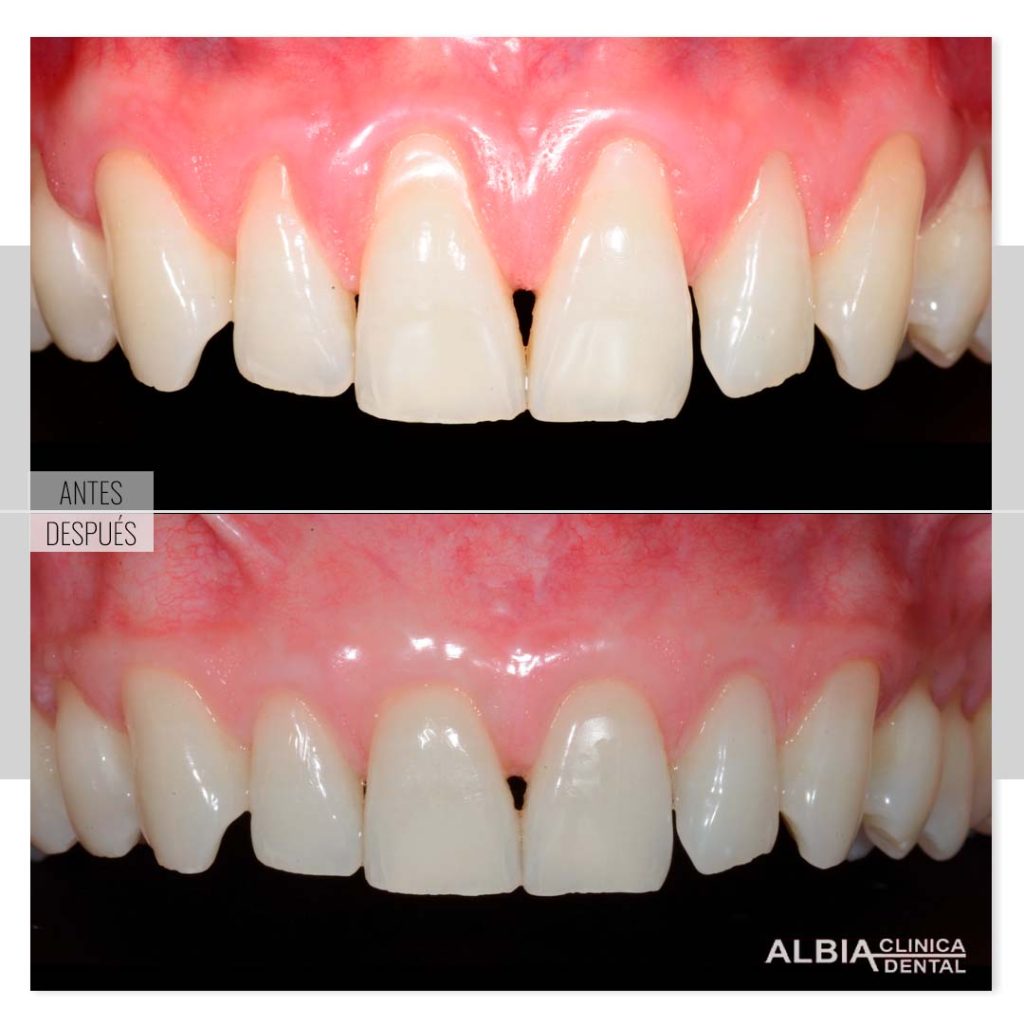 Casos clínicos - Clínica Dental Albia